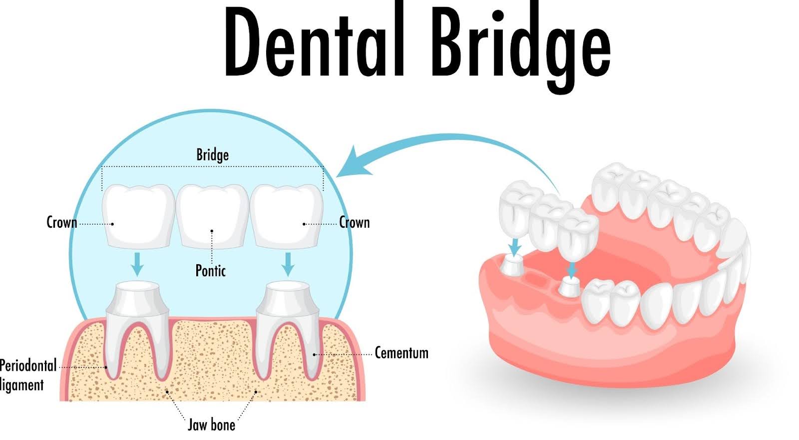 How Long Does a Dental Bridge Last? Understanding Lifespan & Care